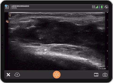 Ultrasound Guided Treatment For Extreme Aesthetic Complications Part 2