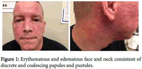 Discrete And Coalescing Pustules Masking Severe Recalcitrant Rosa