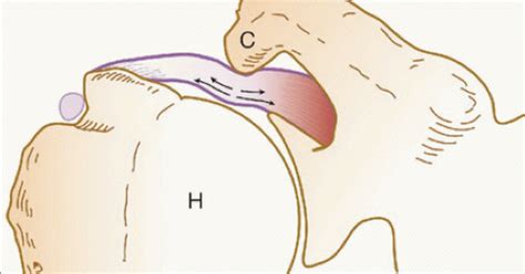 Uw Shoulder And Elbow Academy Coracoid Impingement Is This Something To Worry About