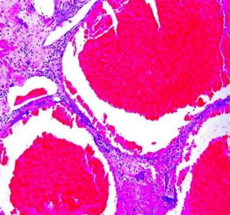 Unicameral Bone Cyst Pathology Orthobullets