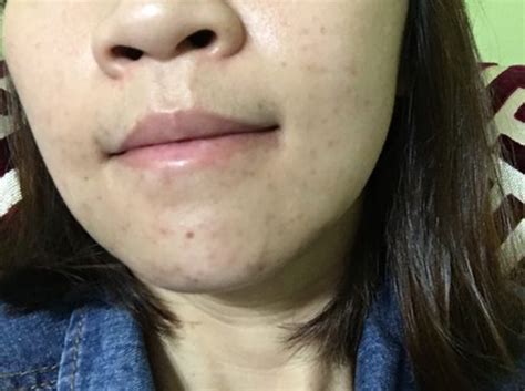 약국 여드름패치 턱 뾰루지 진정 과정 네이버 블로그