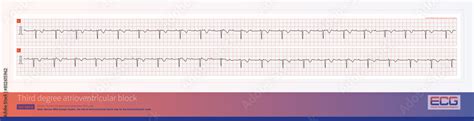 Third Degree Atrioventricular Block In Young Women May Be Congenital With The Block Located On