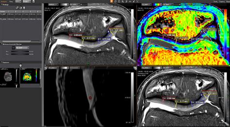 T2 Mapping Canon Medical Systems France