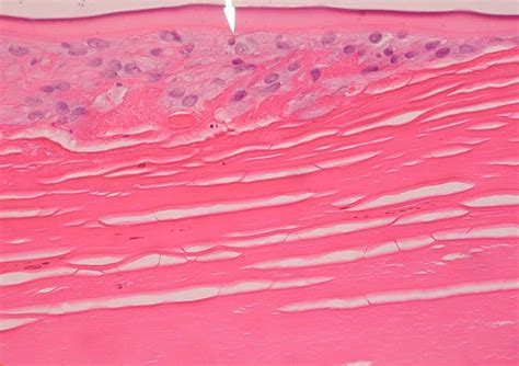 Ocular Pathology Anterior Subcapsular Cataract