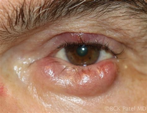 Chalazion Lower Eyelid