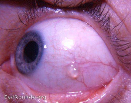 Bulbar Conjunctival Lymph Cyst Online Ophthalmic Atlas