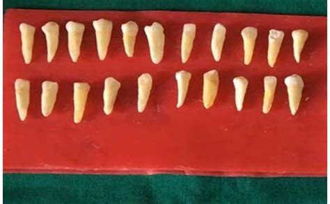 extracted single rooted human teeth download scientific diagram