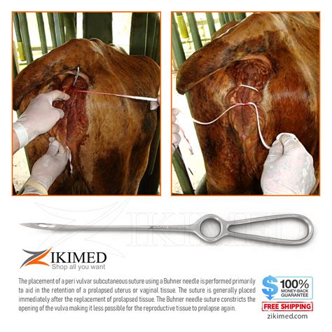 Buhner Suture Needle Stainless Steel Overall Length 12 Zikimed