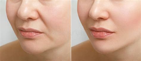 Portrait Of An Aged Woman Before And After The Facelift Procedure The