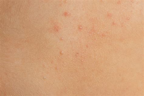 Molluscum Contagiosum Treatment Us Dermatology Partners