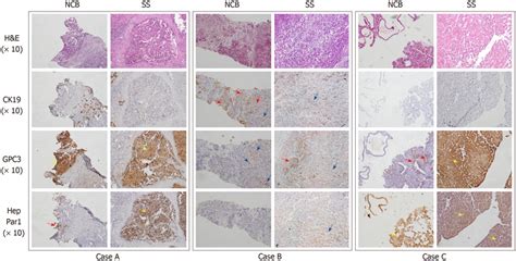 The Four Tier Score Method For Interpretation Of The Ihc Staining Of Download Scientific