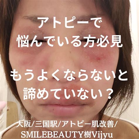 肌トラブル・アトピー改善専門サロングリーンピールニキビ色素沈着大阪三国駅smilebeauty樹vijyu 矢幡美樹 アトピーで
