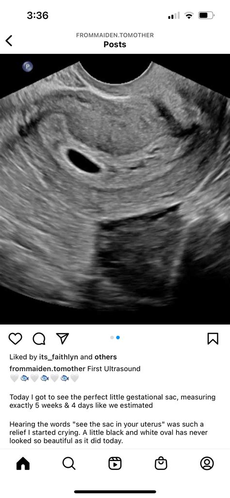 6 Week Transvaginal Ultrasound