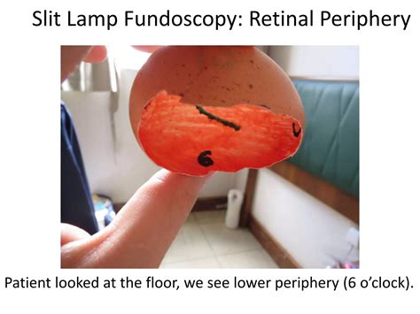 Slit Lamp Fundoscopy Pptx First Aid Injuries
