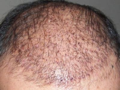 Recensioni Negative Su Trapianto Capelli In Turchia La Verità La Clinica Del Capello La
