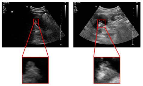 JCM Free Full Text Gallbladder Polyp Classification In Ultrasound
