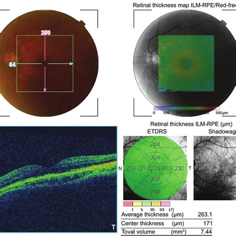 The Average Central Corneal Thickness Cct Blue Columns And Minimum