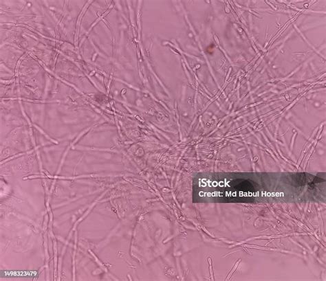 Hifa Semu Dan Sel Ragi Pemula Dalam Urin Pasien Fotomikrograf Dengan