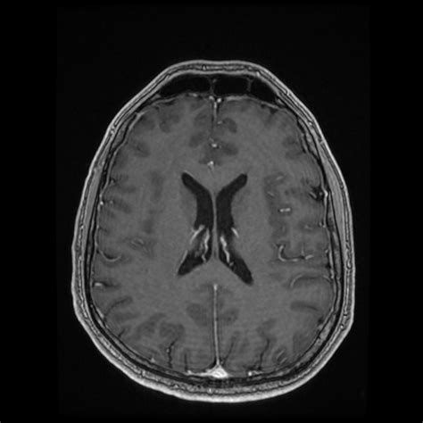 File Cerebral Melanoma Metastasis Meningiomas And Capillary