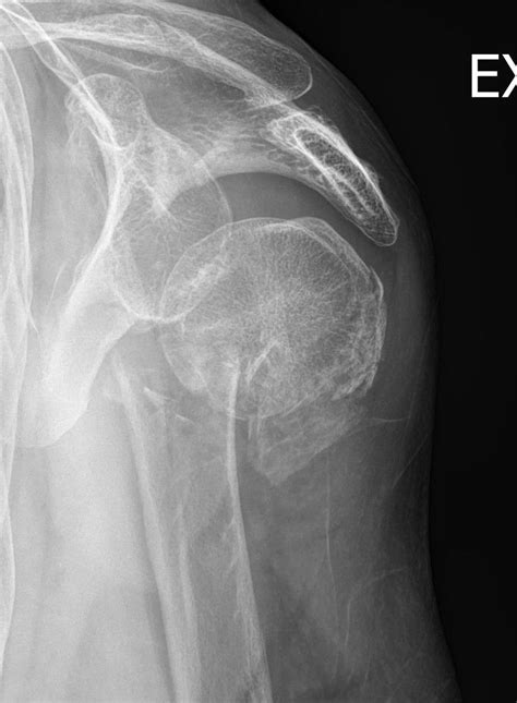 Kashif Ashfaq On Linkedin 88 Year Female Presented After A Fall