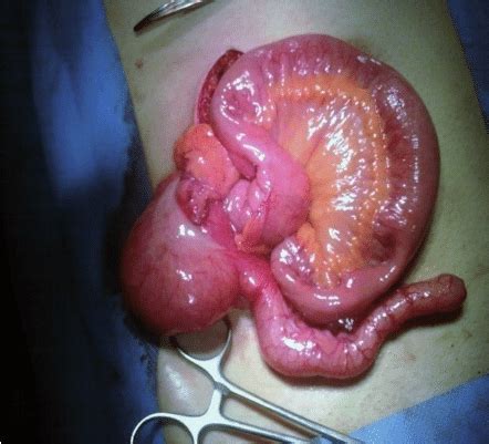 The Appearance Colour And Size Of The Operated Appendix Looked Liked Download Scientific