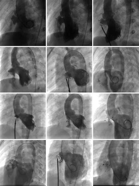 Patient 1 A C 6 Year Old Boy Weighing 20 Kg A Angiography Shows