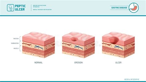 Ulcer Diagram Stock Illustrations 866 Ulcer Diagram Stock Illustrations Vectors And Clipart