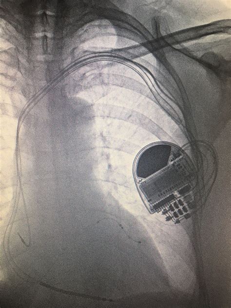 Implantable Cardioverter Defibrillator Icd And Cardiac