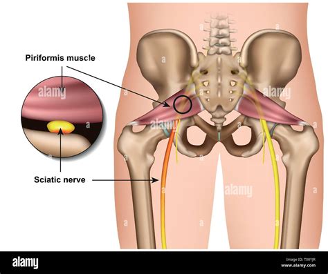 Piriformis Syndrome 3d Medical Vector Illustration On White Background