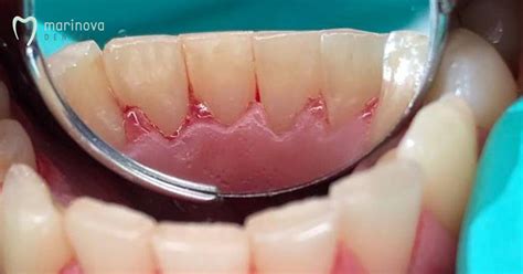 Почистване на зъбен камък с най доброто оборудване Marinova Dental Clinic