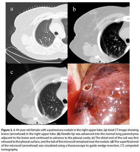 Ct Guided Microcoil Localization For Scapula Blocked Pulmonary Nodules