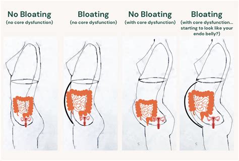 Endo Belly Symptoms At Jackson Mcpherson Blog