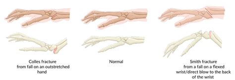 Understanding Colles Fracture Causes And Treatment El Paso Tx Doctor Of Chiropractic