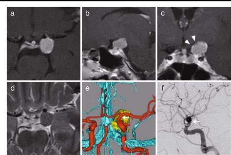 Structure Of Posterior Clinoid Process Semantic Scholar