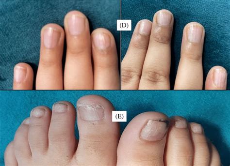 Remarkable Improvement In The Fingernails And Toenails After Eight