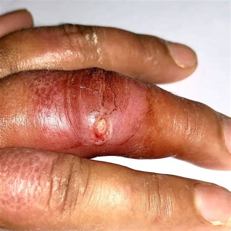 عفونت انگشت نکاتی که باید در مورد عفونت انگشت بدانید مجله پل ایده