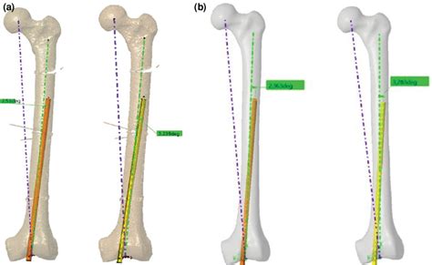 Maximal Angulation Errors For 5 Mm Orange And 10 Mm Yellow Medial