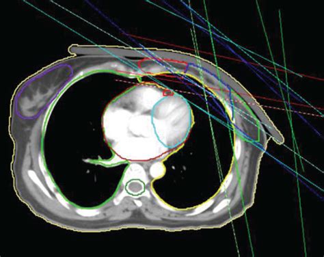 A Beam View Of Ptv Sc And Ptv B Beam View Of The Ptv Exclude The