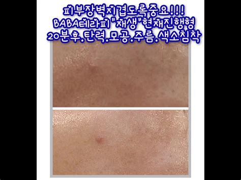 탄력 리프팅 얼굴형 주름 모공 피부톤 색소침착 한병에 동서융합화장품 케이셀채움baba 항상성 재현성 문제