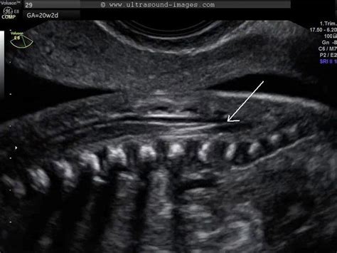 Spina Bifida 3d Ultrasound