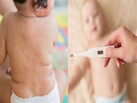 Sesta Malattia Sintomi Contagio E Incubazione Passione Mamma