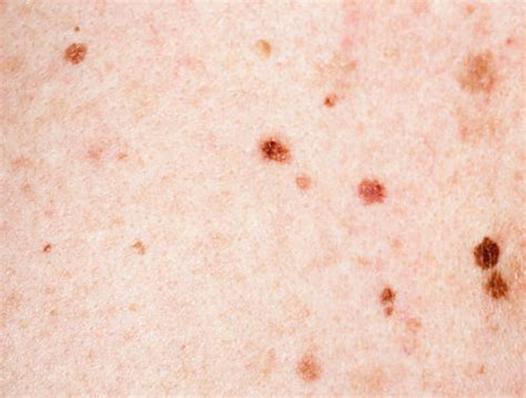 How To Get Rid Of Brown Spots On Skin Top 10 Home Remedies