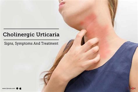Cholinergic Urticaria Signs Symptoms And Treatment By Dr Deepak