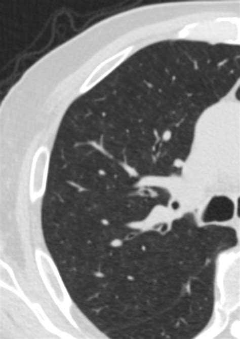 181lu Copd Chronic Bronchitis And Pulmonary Hypertension The Common Vein
