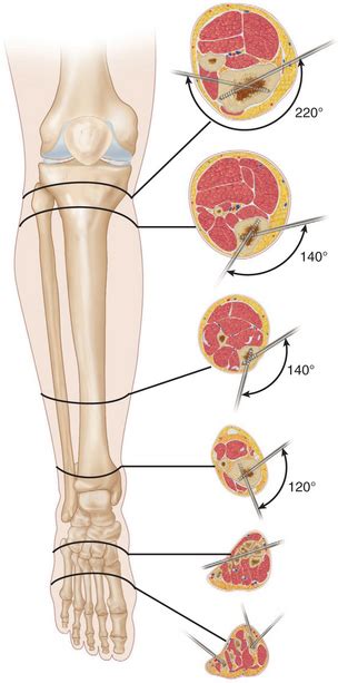 External Fixation Of Distal Tibial Fractures Musculoskeletal Key