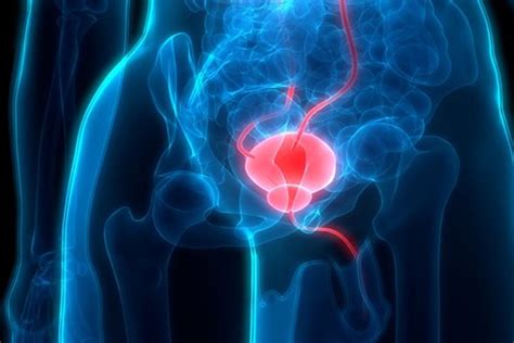 Understanding The Cost Of Prostate Artery Embolization Best Treatment