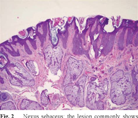 Figure 2 From Sebaceous Neoplasms In Siriraj Hospital Mahidol