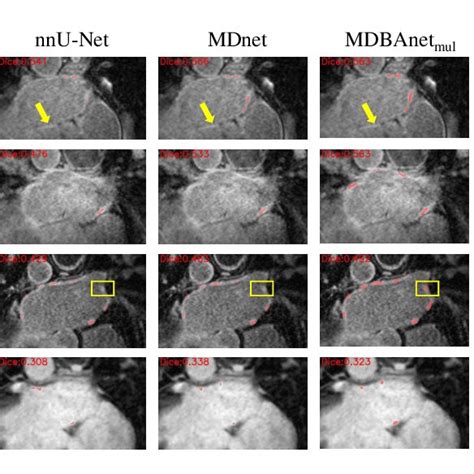 Visualization Of Different Scar Segmentation Methods Yellow Arrows Download Scientific Diagram