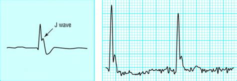 mrcp revision j wave