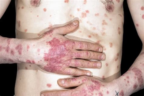 Guttate Psoriasis Causes Symptoms And Treatment